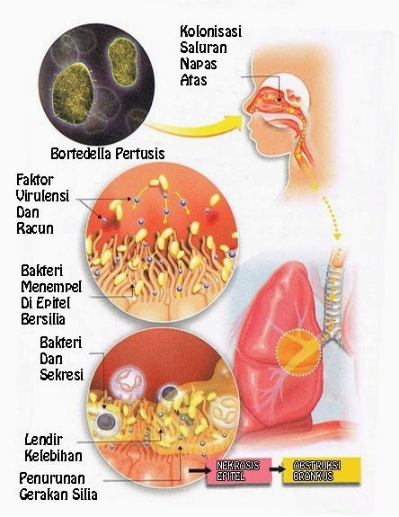 Batuk Rejan - Obat Tradisional Batuk Rejan, Gejala , Penyebab Serta ...
